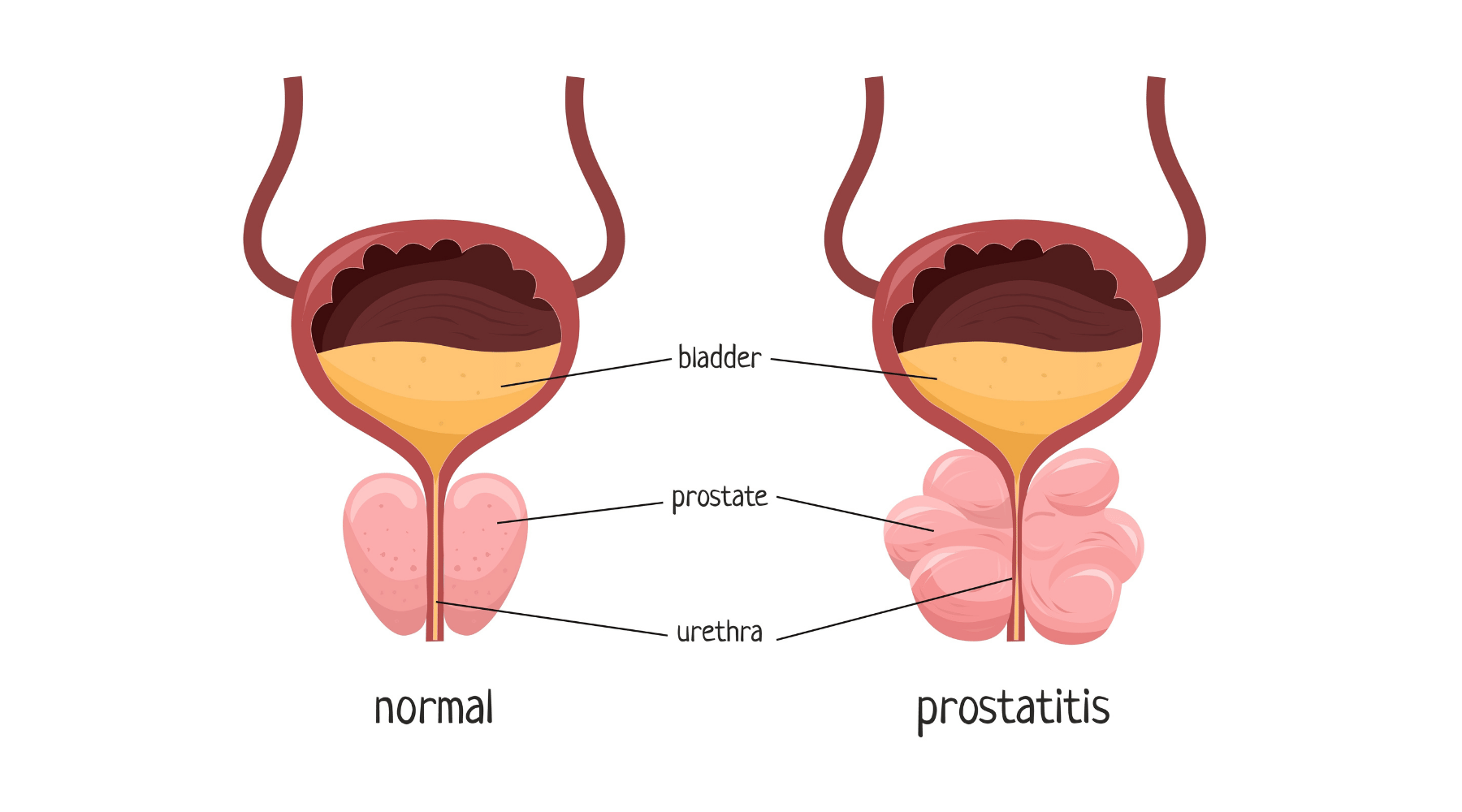 Is Chronic Pain a Sign of Prostatitis? Discover the Symptoms You Shoul